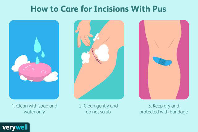 What is Pus? Causes and Treatment