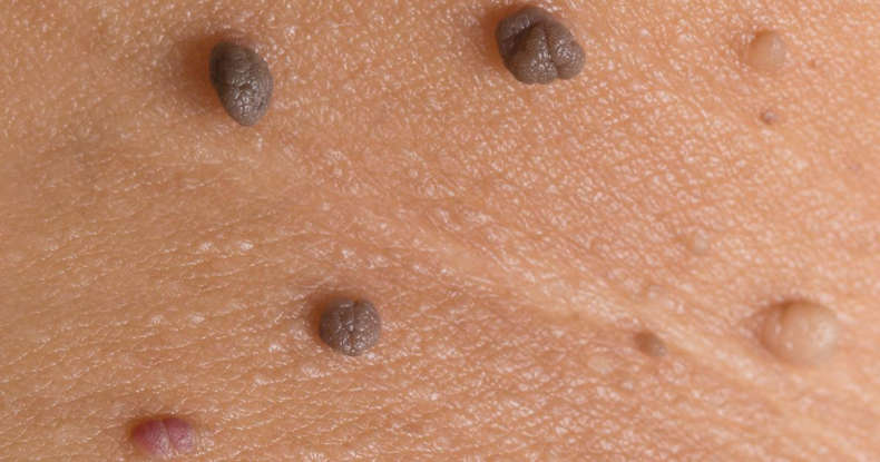 Guide To Prevention And Treatment Options For Moles Guide To Prevention And Treatment Options For Moles