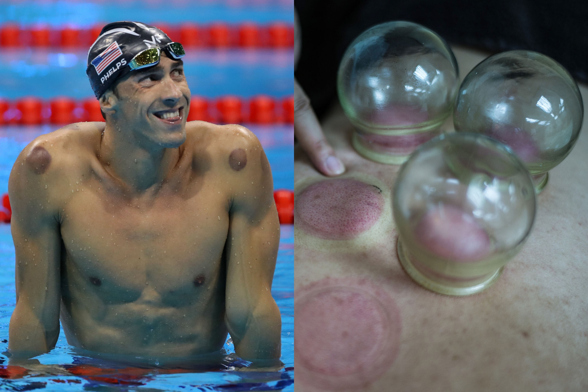 Marques circulaires sur le corps des sportifs : explications et raisons