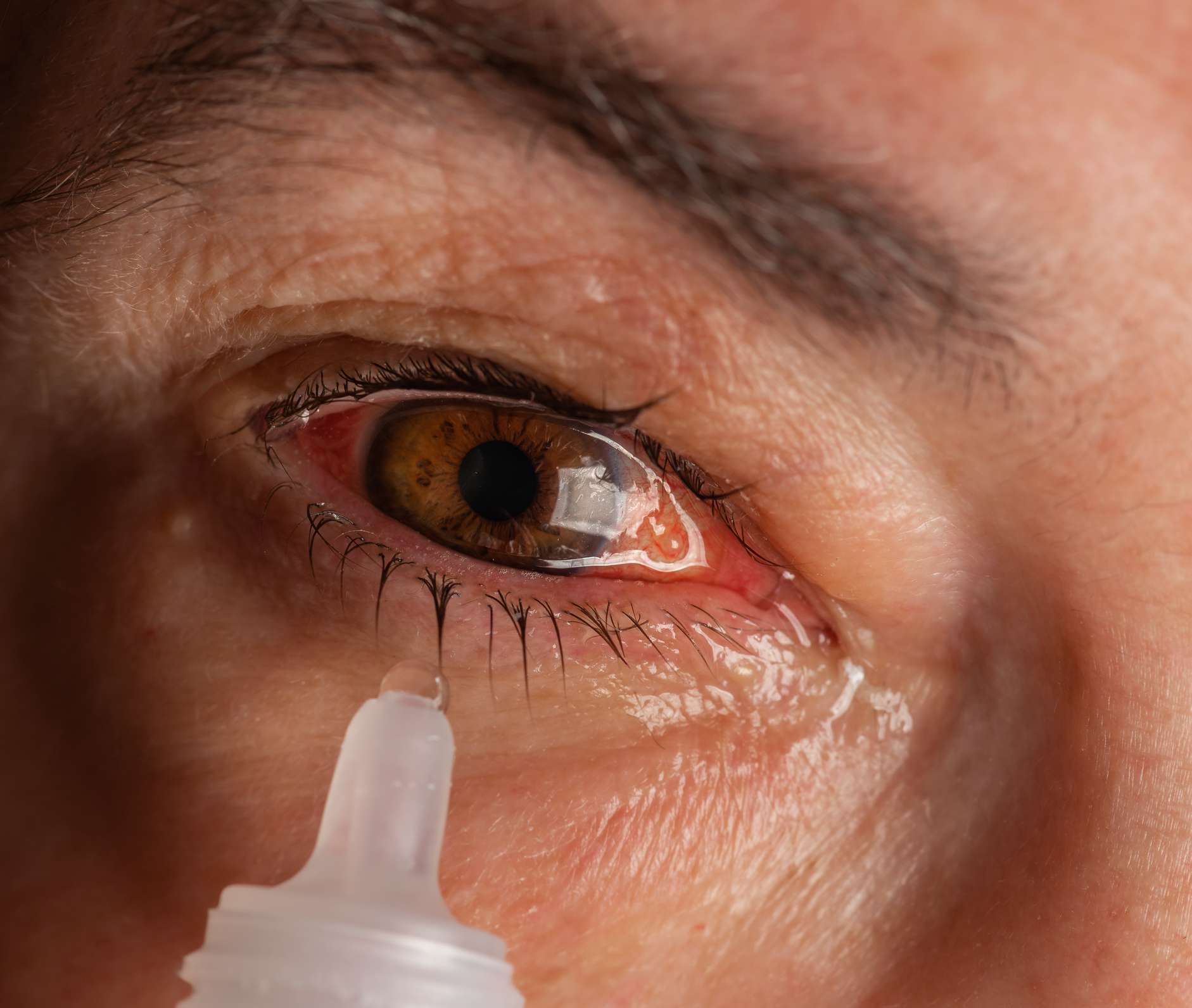 What Eye Drops Are Best for Pink Eye (Conjunctivitis)?