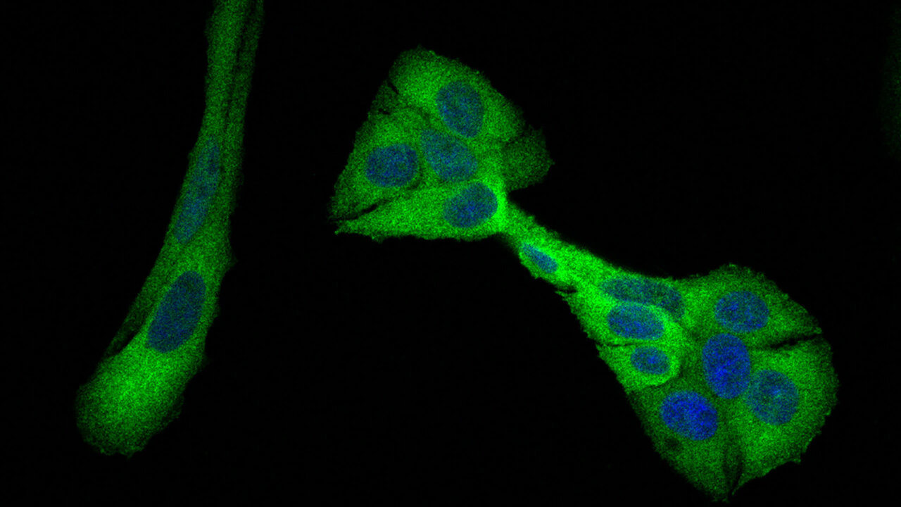 Scientists find way to starve breast cancer cells Scientists find way to starve breast cancer cells