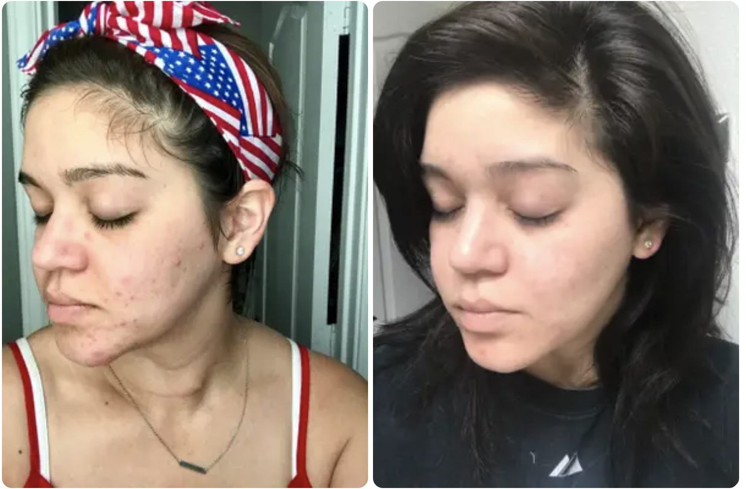 33 Skincare Products With Before & After Photos So Dramatic, We Made ...