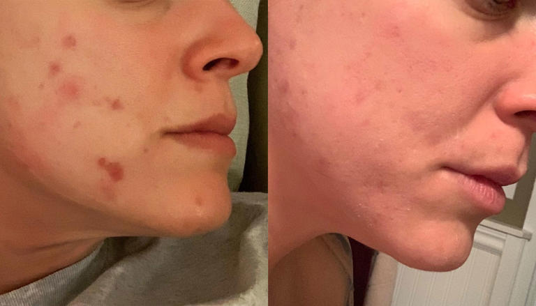 33 Skincare Products With Before & After Photos So Dramatic, We Made ...