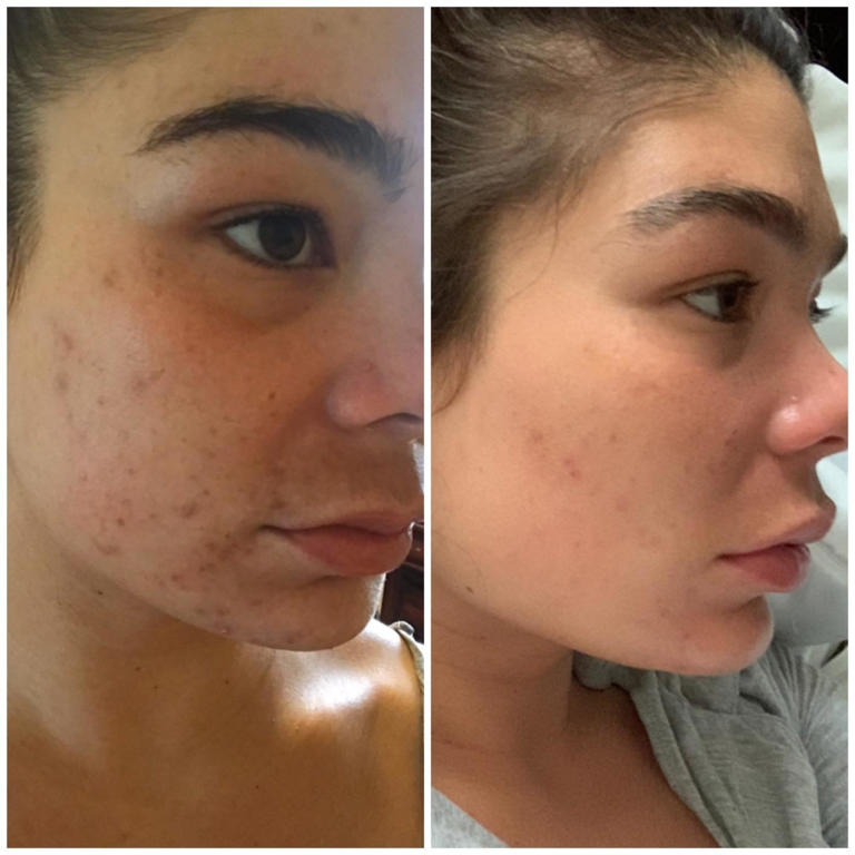 33 Skincare Products With Before & After Photos So Dramatic, We Made Them Click To Reveal