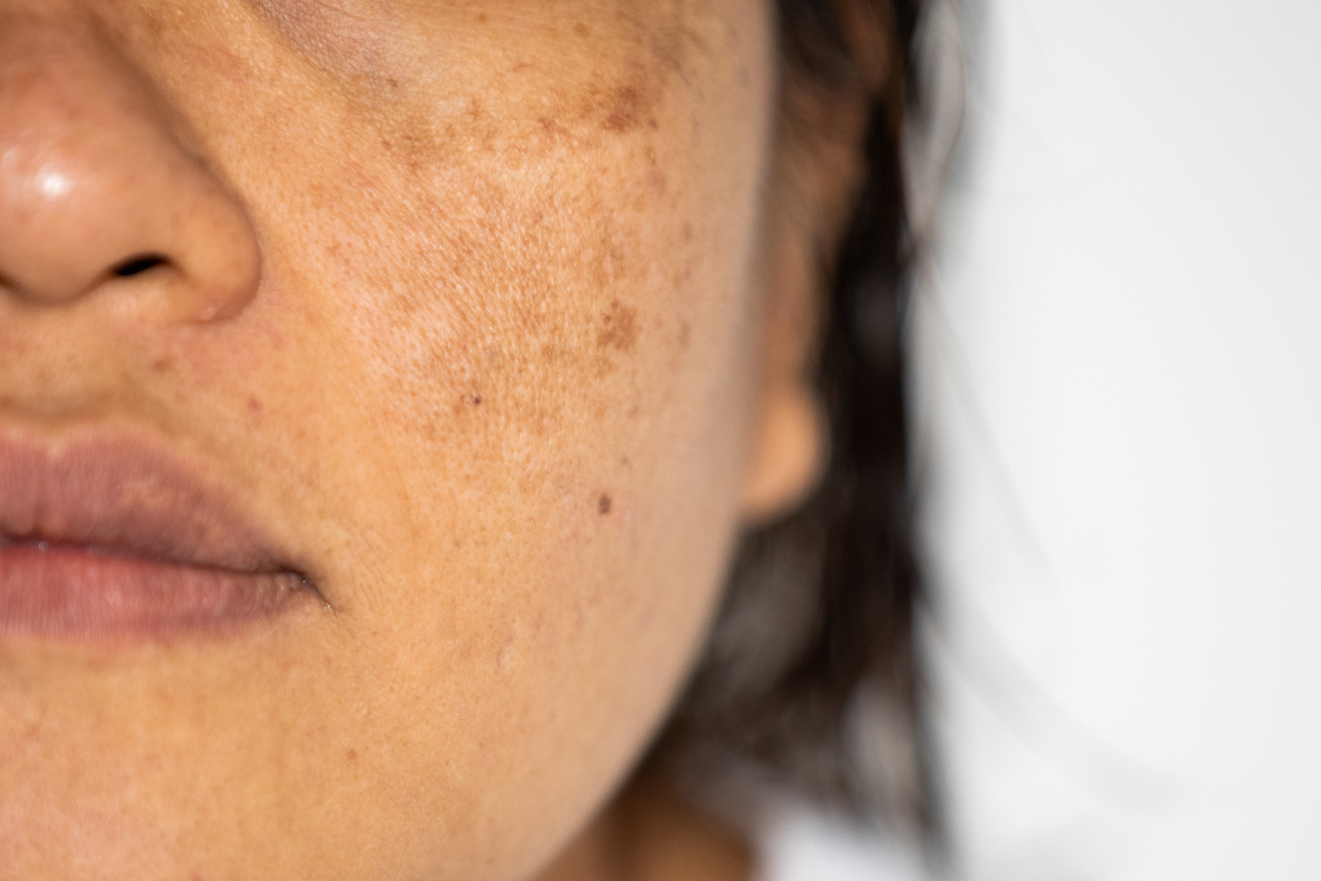 Tout ce que vous devez savoir sur le mélasma