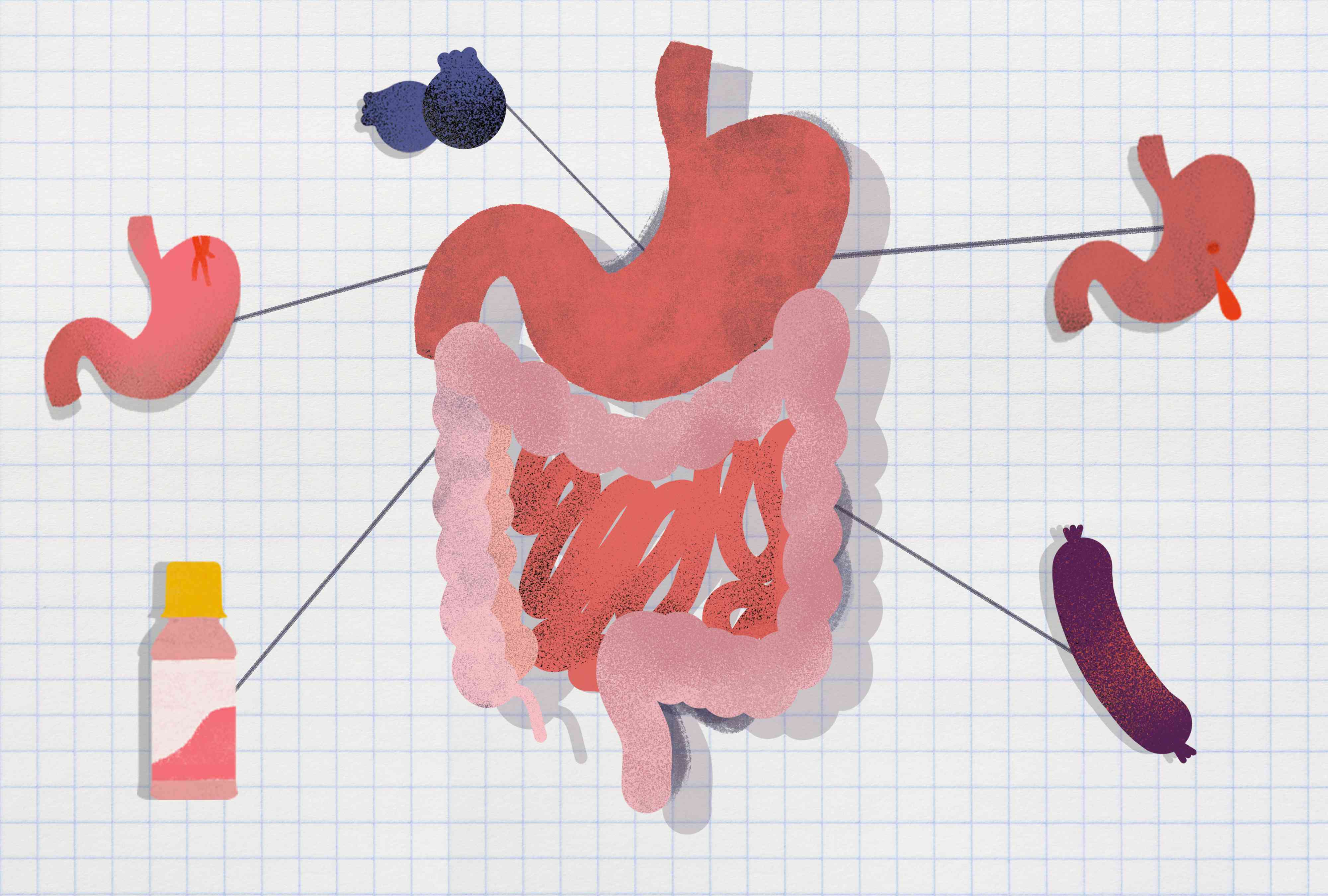 Black Poop: When It's Harmless and When It's Not