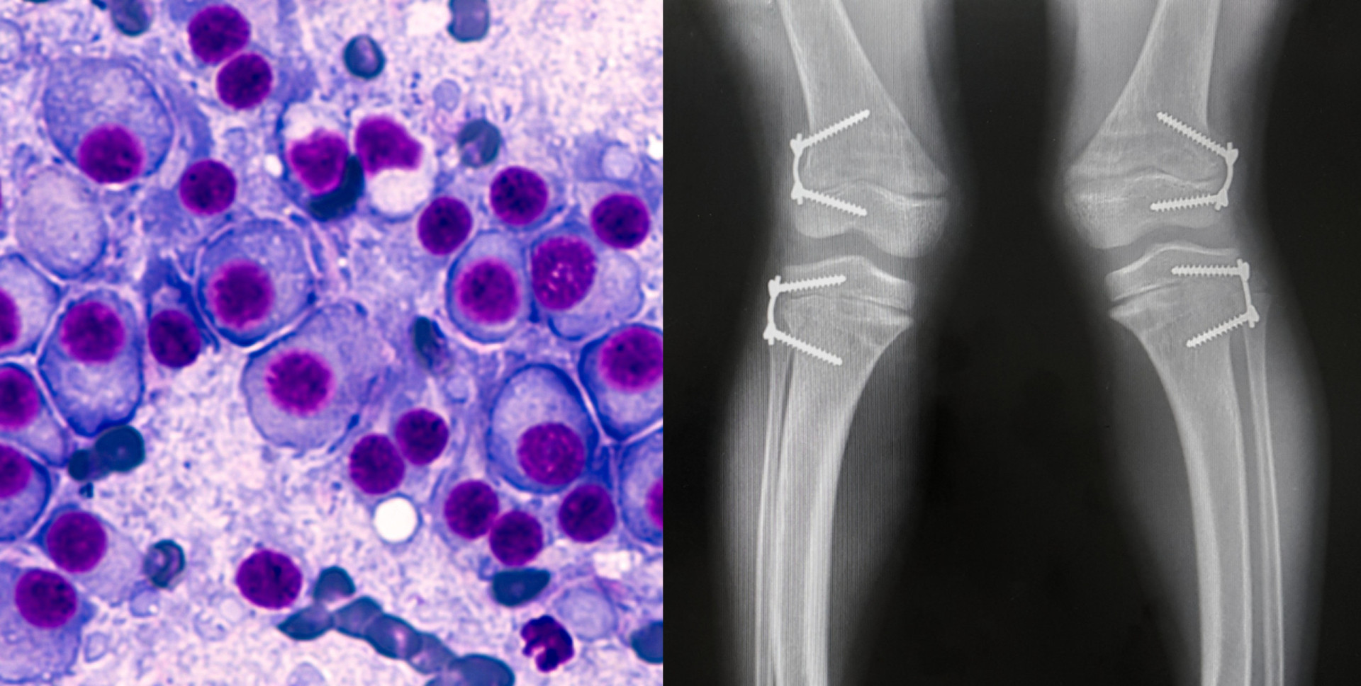 Découvrez les maladies osseuses et articulaires les plus fréquentes