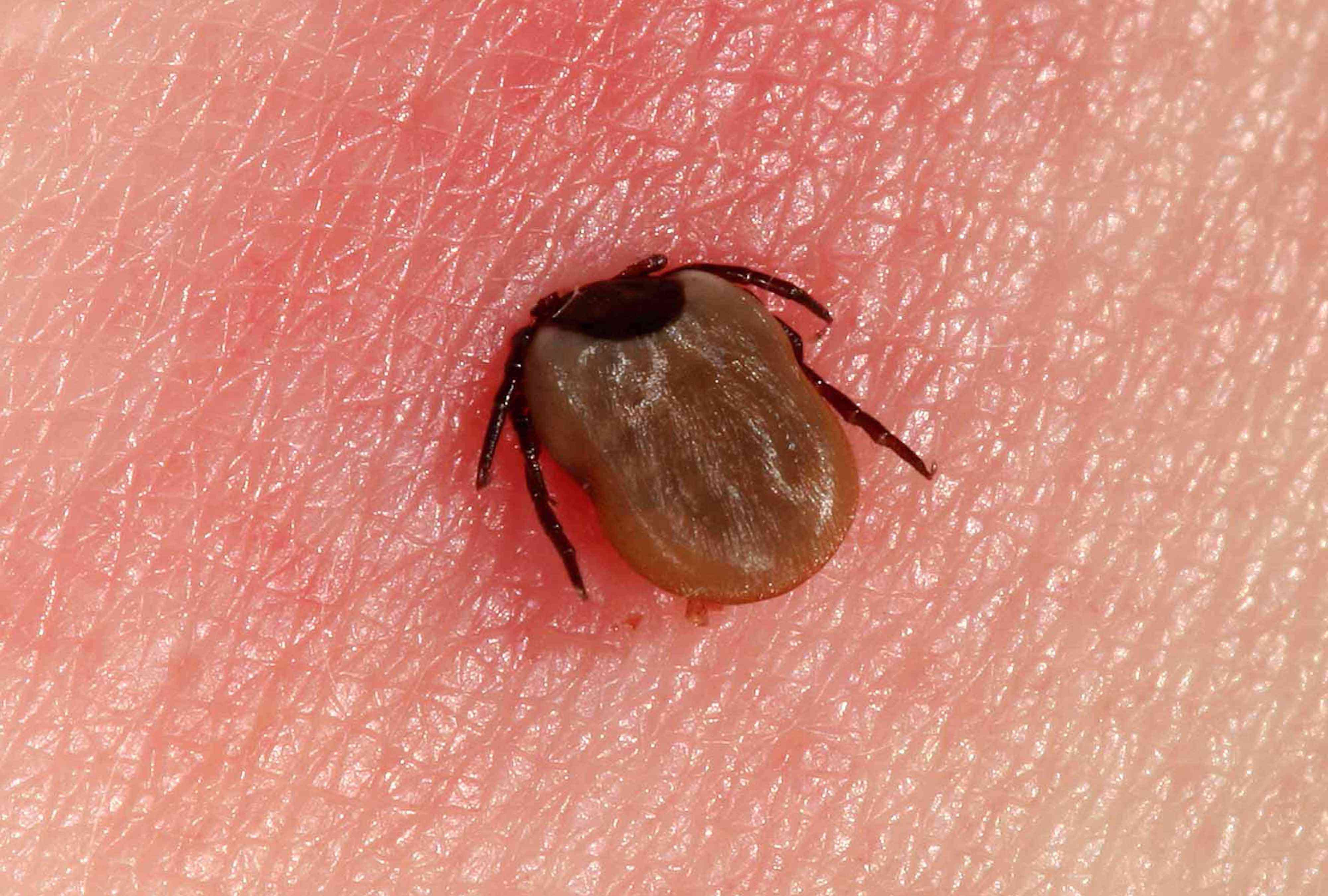 What Does a Tick Bite Look Like? Signs and Pictures