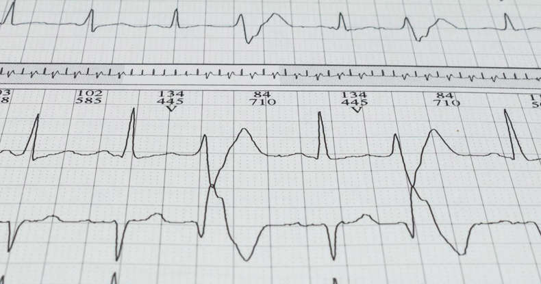 10 Unraveling Mysteries: Navigating the Labyrinth of Aortic Stenosis ... 10 Unraveling Mysteries: Navigating the Labyrinth of Aortic Stenosis ...