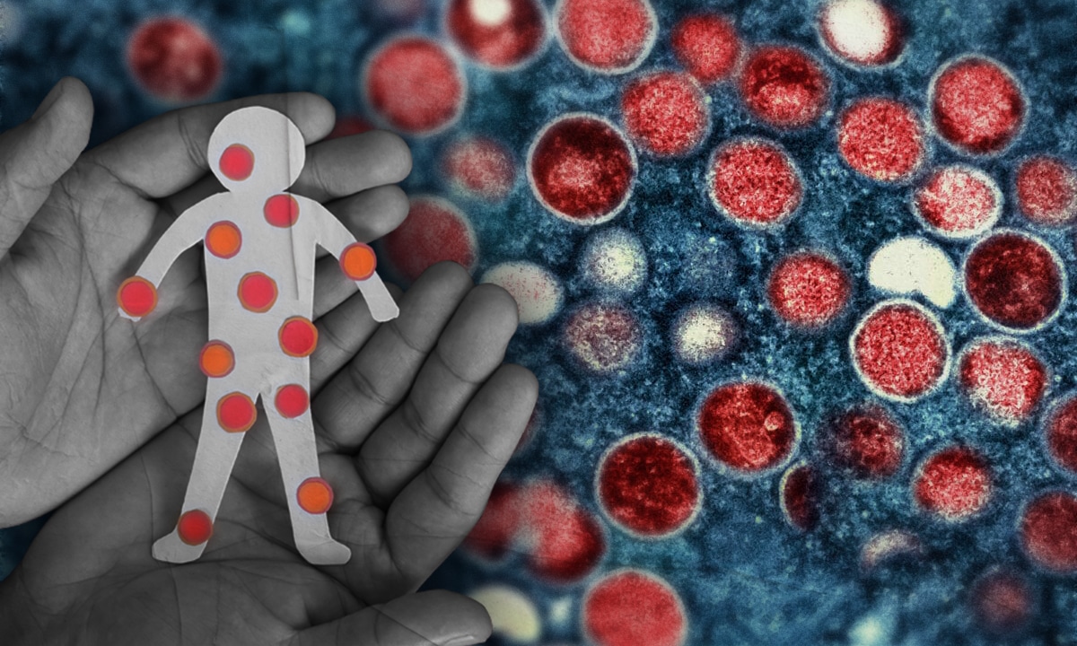 Eastern Visayas records first mpox case