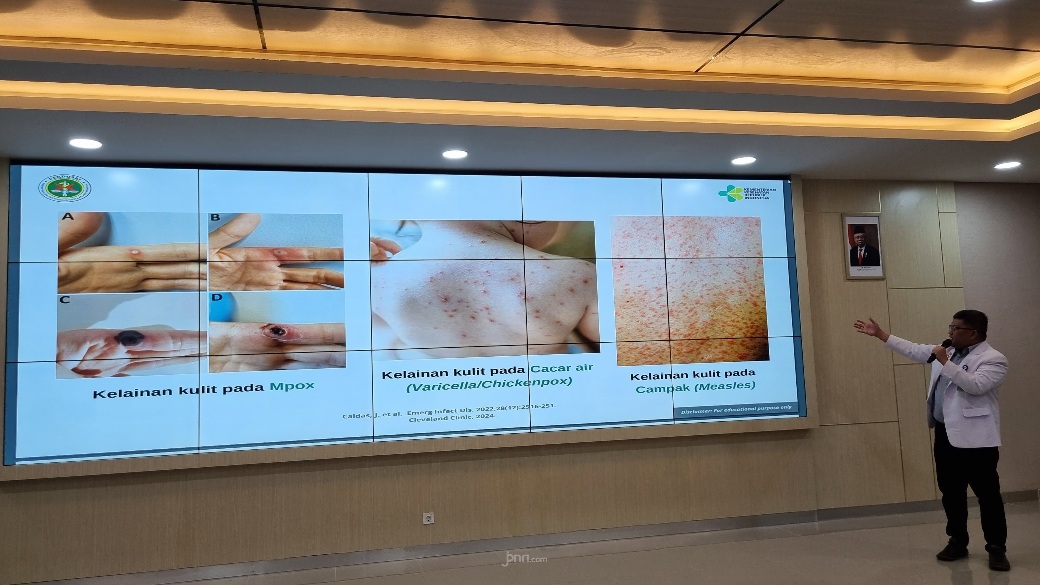 RSHS Bandung Ternyata Pernah Merawat 2 Pasien Positif Mpox pada 2023 ... RSHS Bandung Ternyata Pernah Merawat 2 Pasien Positif Mpox pada 2023 ...