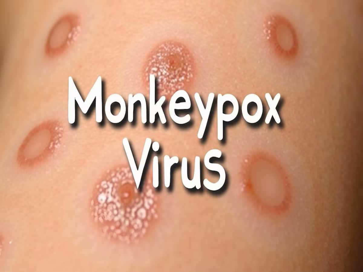 Suspected Mpox Case In Kerala’s Malappuram Amid Nipah Scare: State On ... Suspected Mpox Case In Kerala’s Malappuram Amid Nipah Scare: State On ...