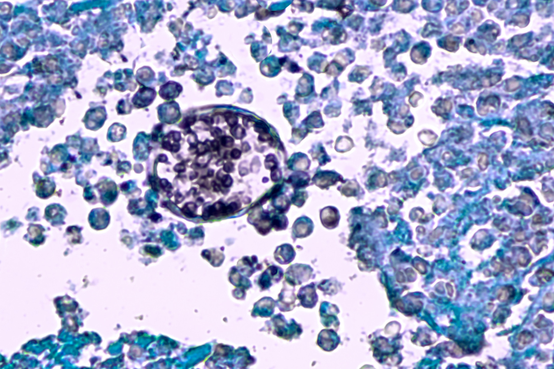 Climat : alerte sur un champignon mangeur de chair