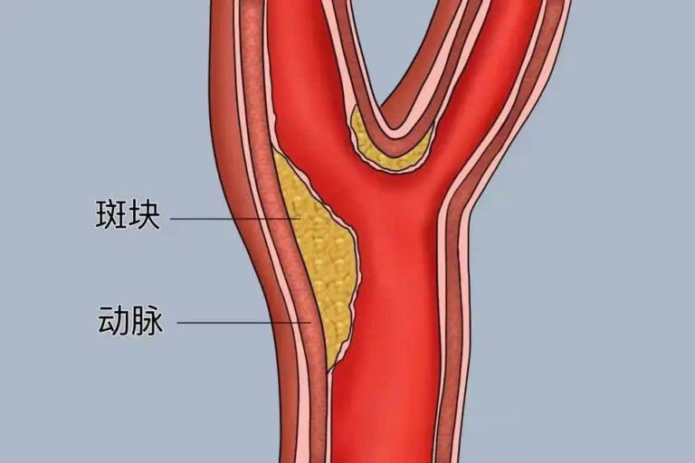 55岁女子一年后血管斑块消失！养成5个习惯，斑块或可慢慢消除