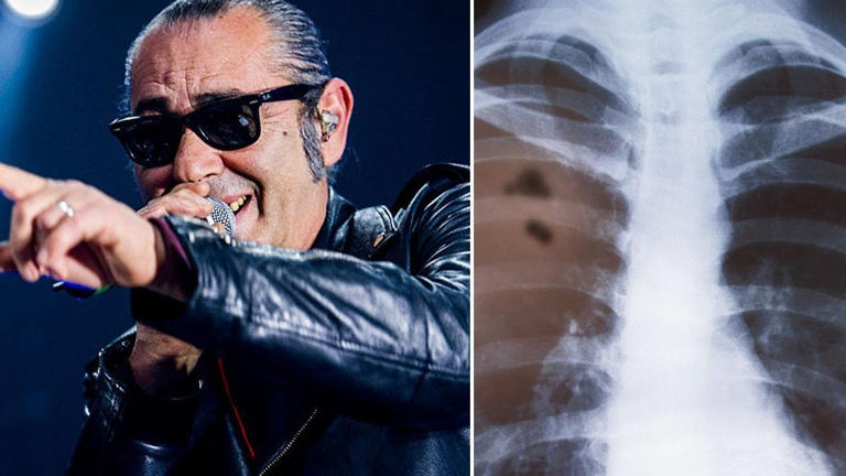 Quali Sono I Primi Sintomi Di Un Tumore Al Polmone E Come Ha Fatto Luca Carboni A Scoprire La
