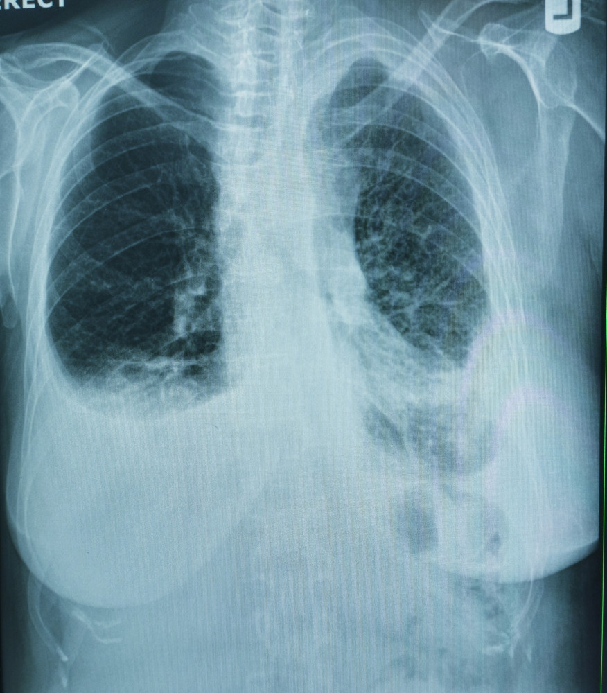 Vier personen om het leven gekomen door 'droog verdrinking'. Wat is dit ...