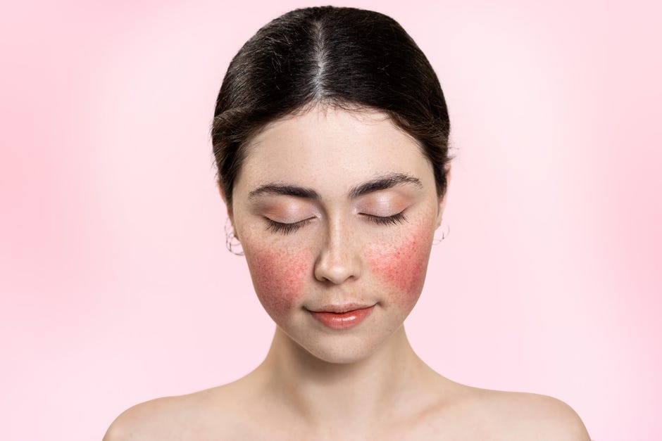 Rosacea: A Complete Guide to Symptoms, Causes and 5 Treatments to Try