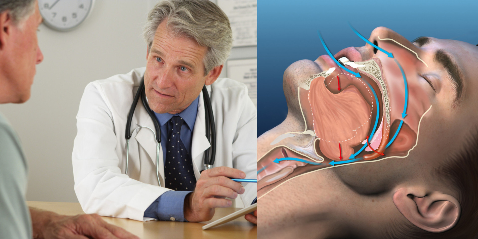 Comment mettre fin aux ronflements