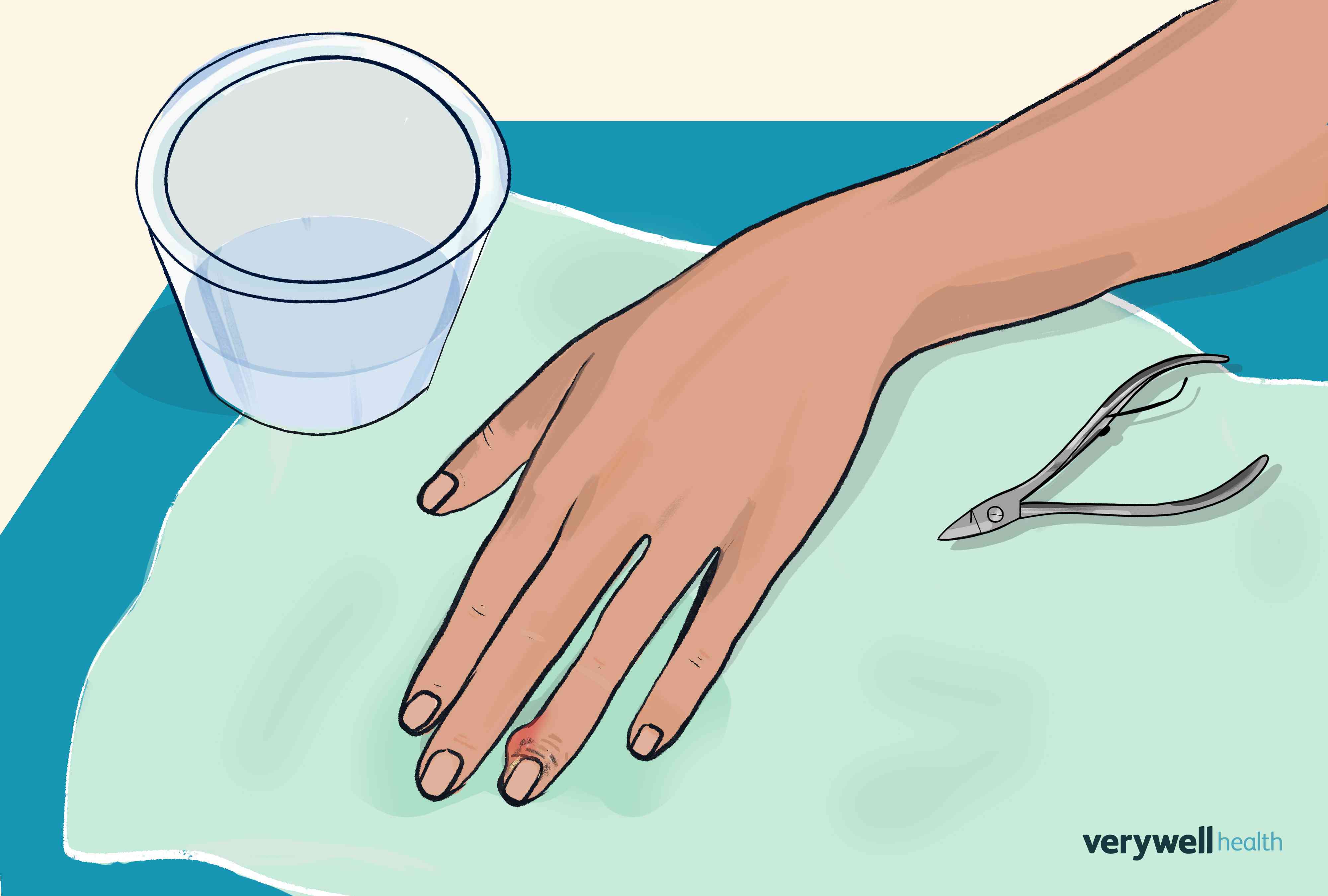 How to Spot and Care for an Infected Hangnail