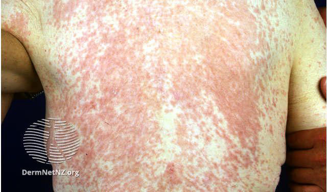 Drug Rash: Which Drugs Cause Skin Symptoms?