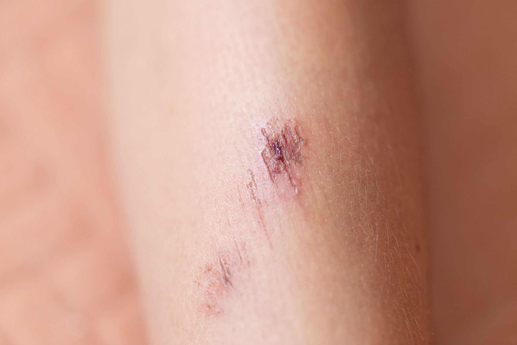 What Are Scabs and How Do They Heal?