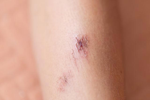What Are Scabs and How Do They Heal?