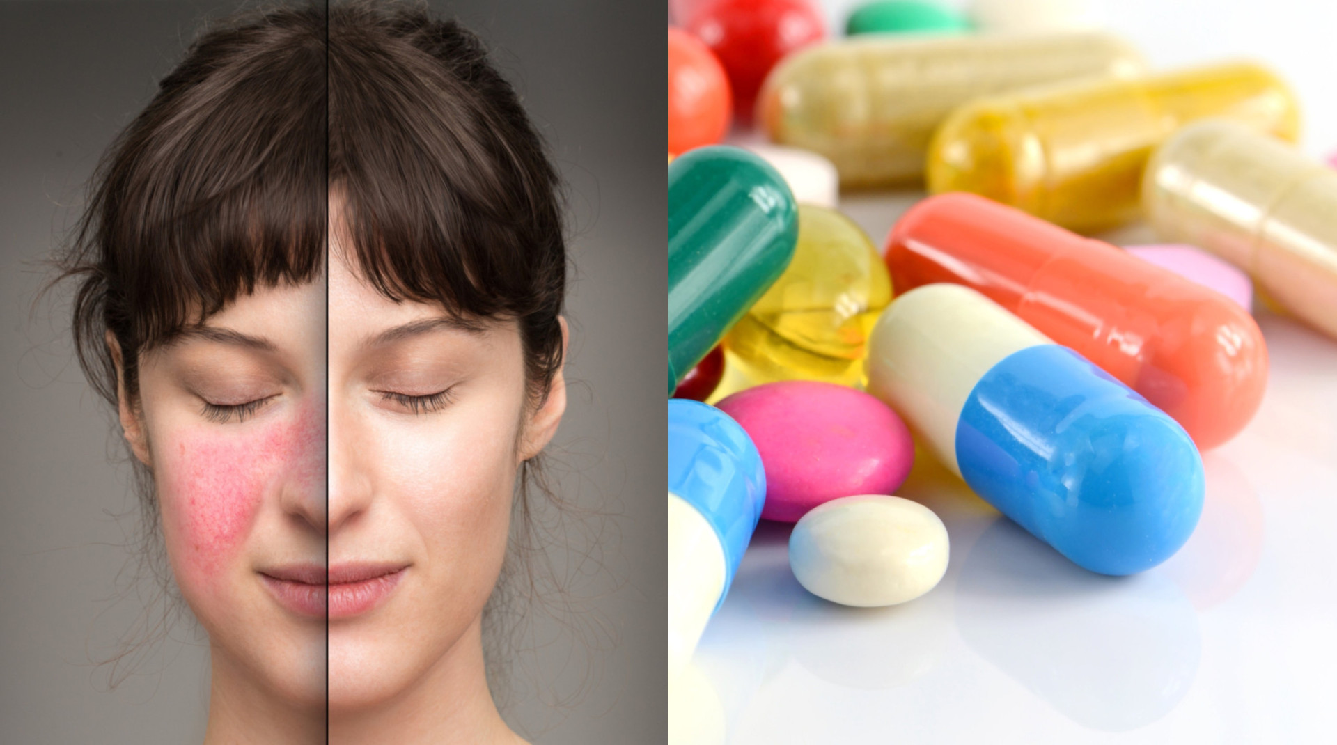 Maladie de peau : vivre avec la rosacée