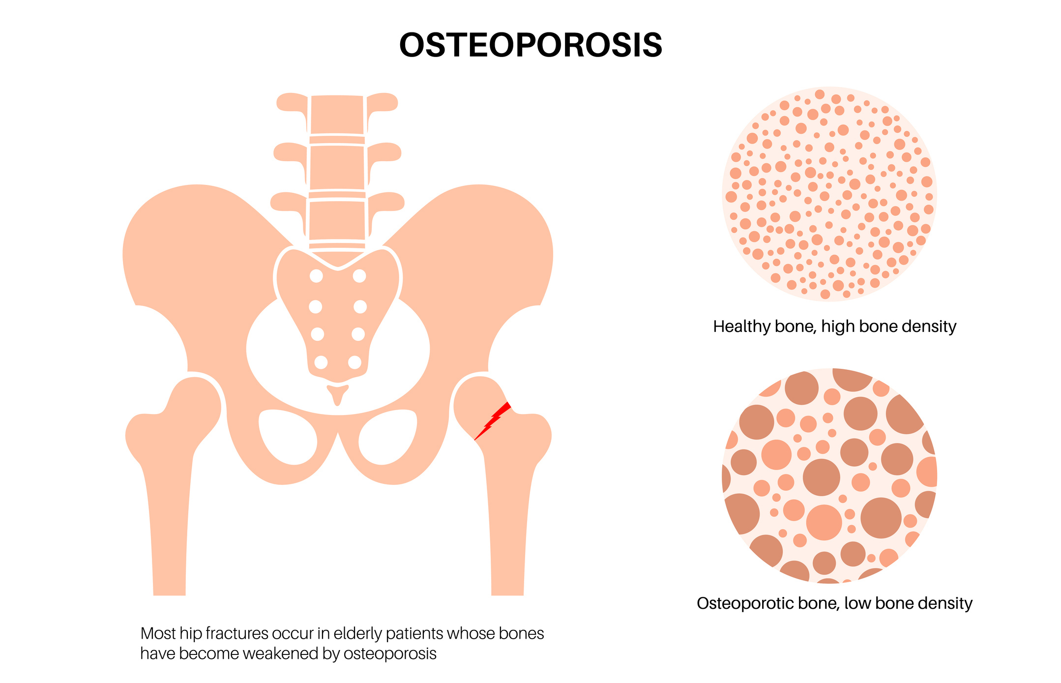 5 Easy Ways To Build Bone Density Naturally and Prevent Osteoporosis 5 Easy Ways To Build Bone Density Naturally and Prevent Osteoporosis