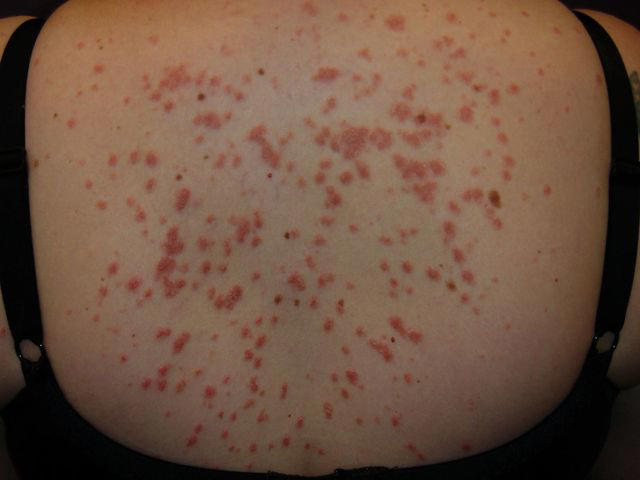 Everything You Need to Know About Guttate Psoriasis