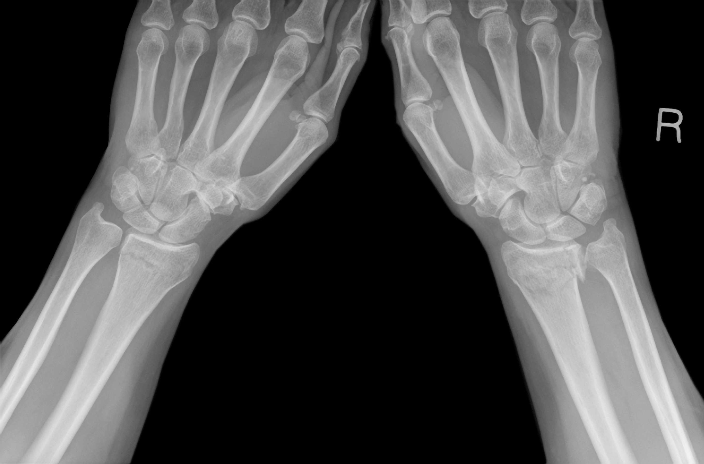 Physical therapy for a Colles fracture