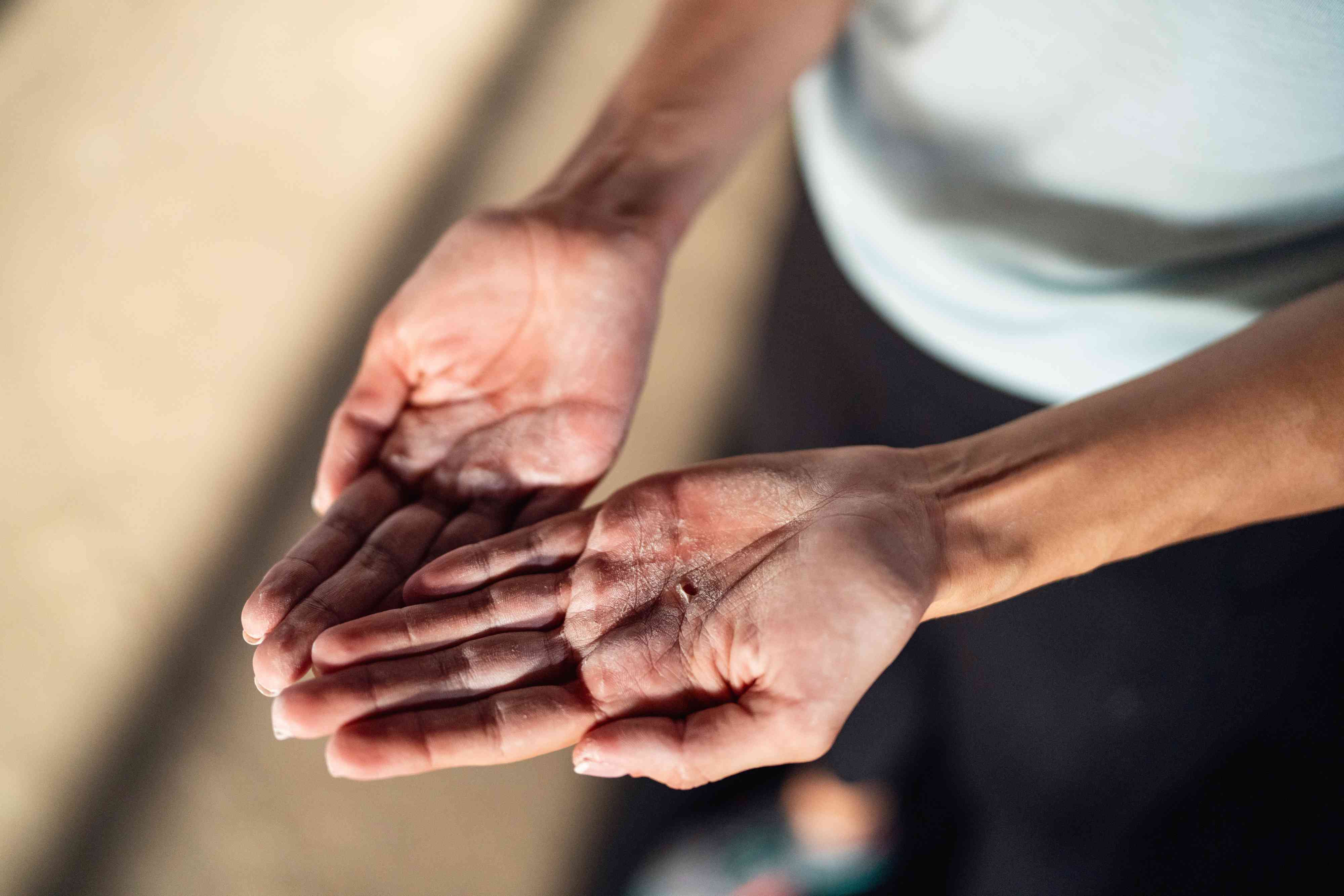 Calluses on Hands and Fingers: Why They Form and What to Do