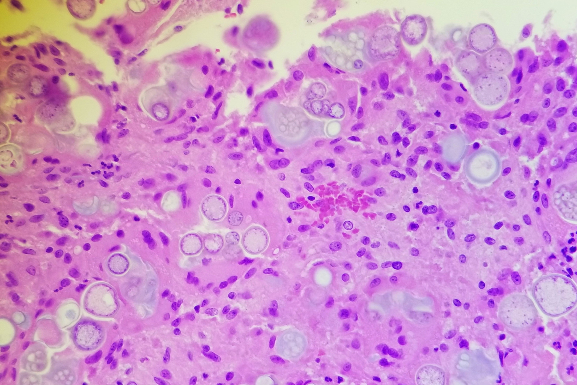 Like 'The Last of Us': potentially deadly fungi are on the rise