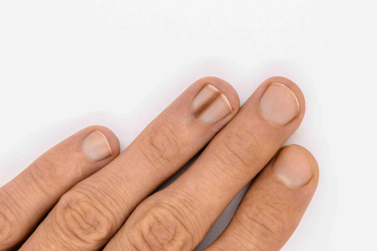 What Causes a Black Line on Your Nail (Melanonychia)?