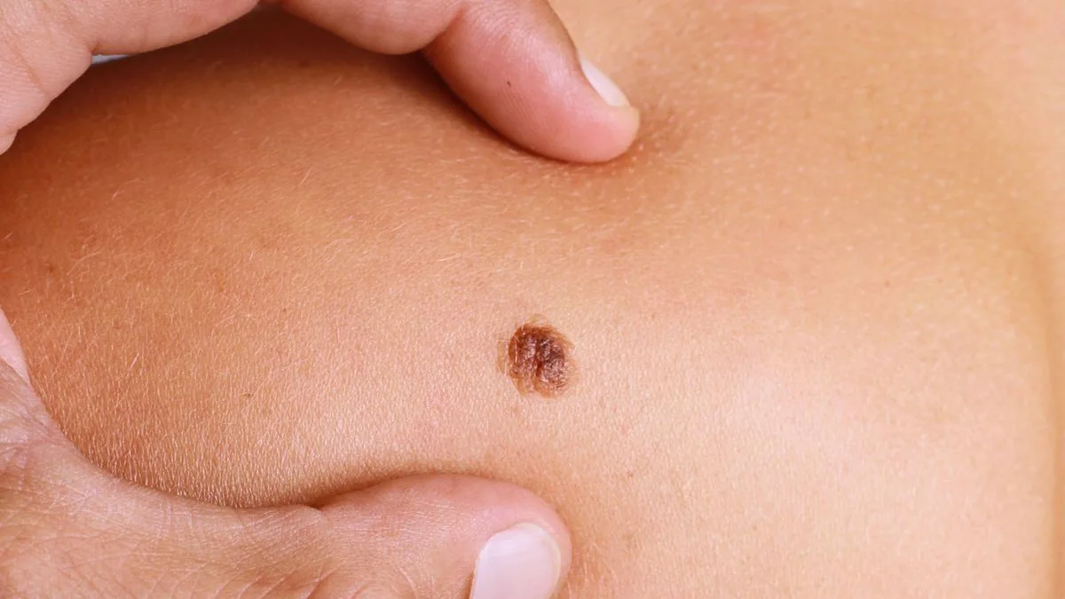 Las diferencias entre un lunar sano y uno cancerígeno: las claves para ...