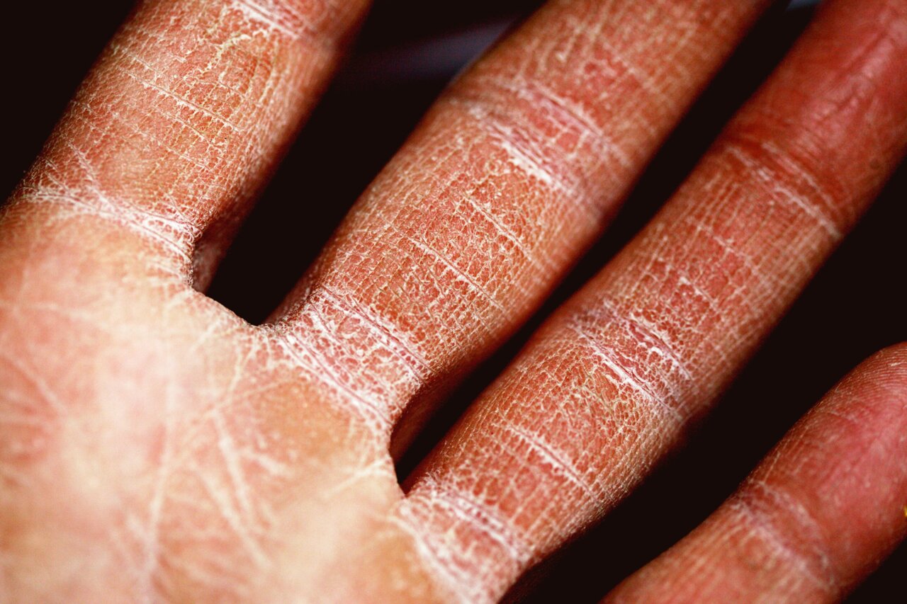 Skin injury may bring on food allergies