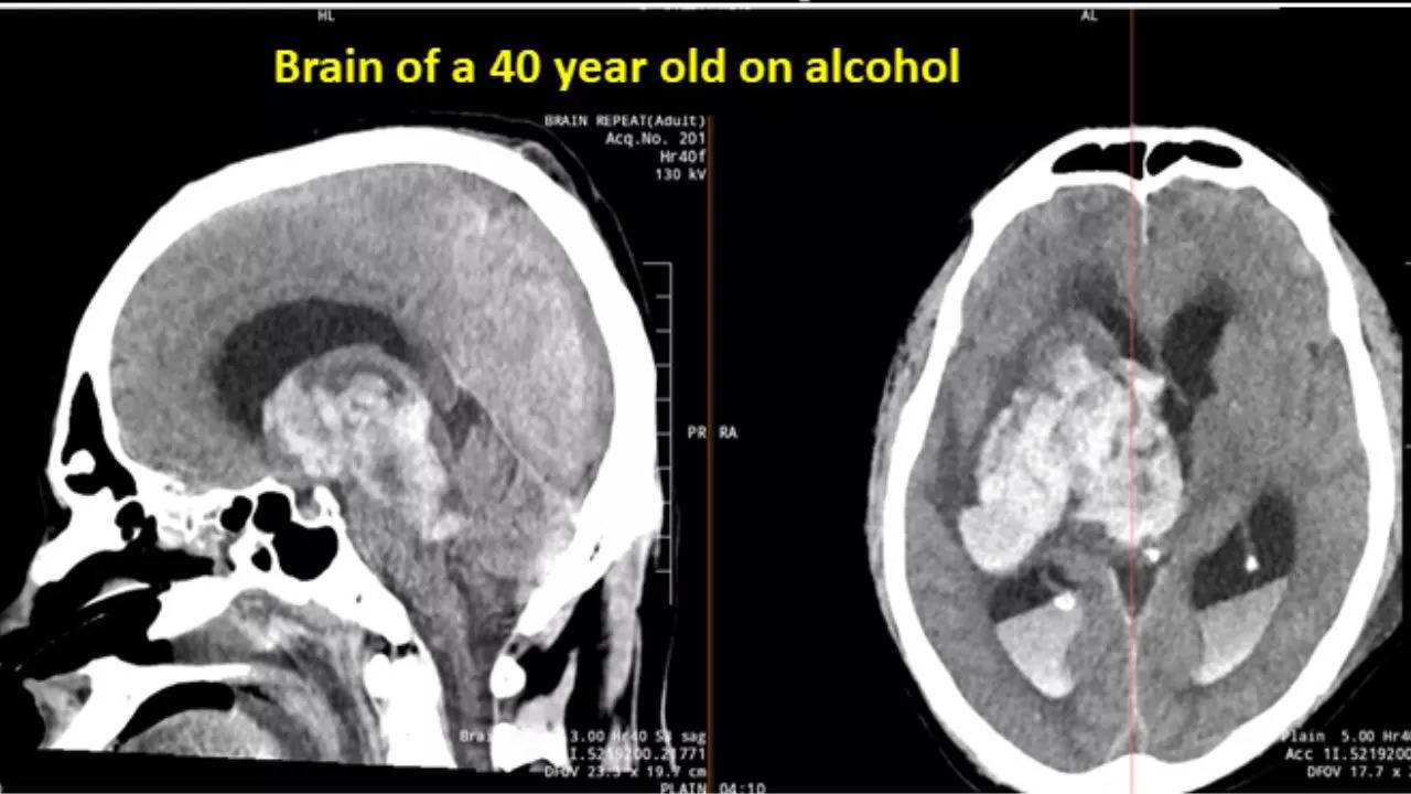 Brain Stroke Warning! The Liver Doc Shares Shocking Brain Scan Of 40 ... Brain Stroke Warning! The Liver Doc Shares Shocking Brain Scan Of 40 ...