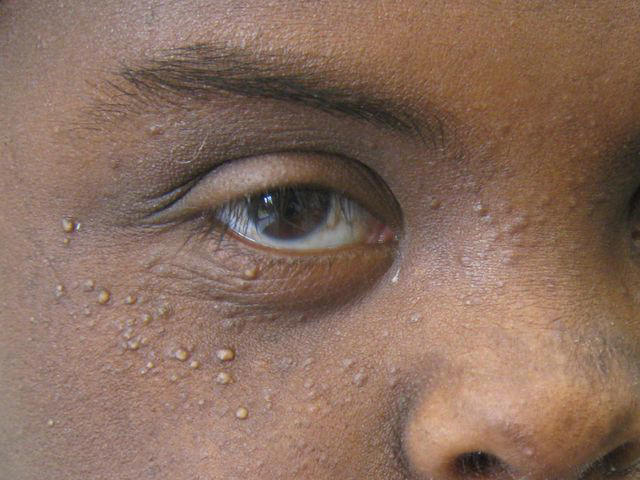 7 skin bumps on your face that aren't acne (with pictures)