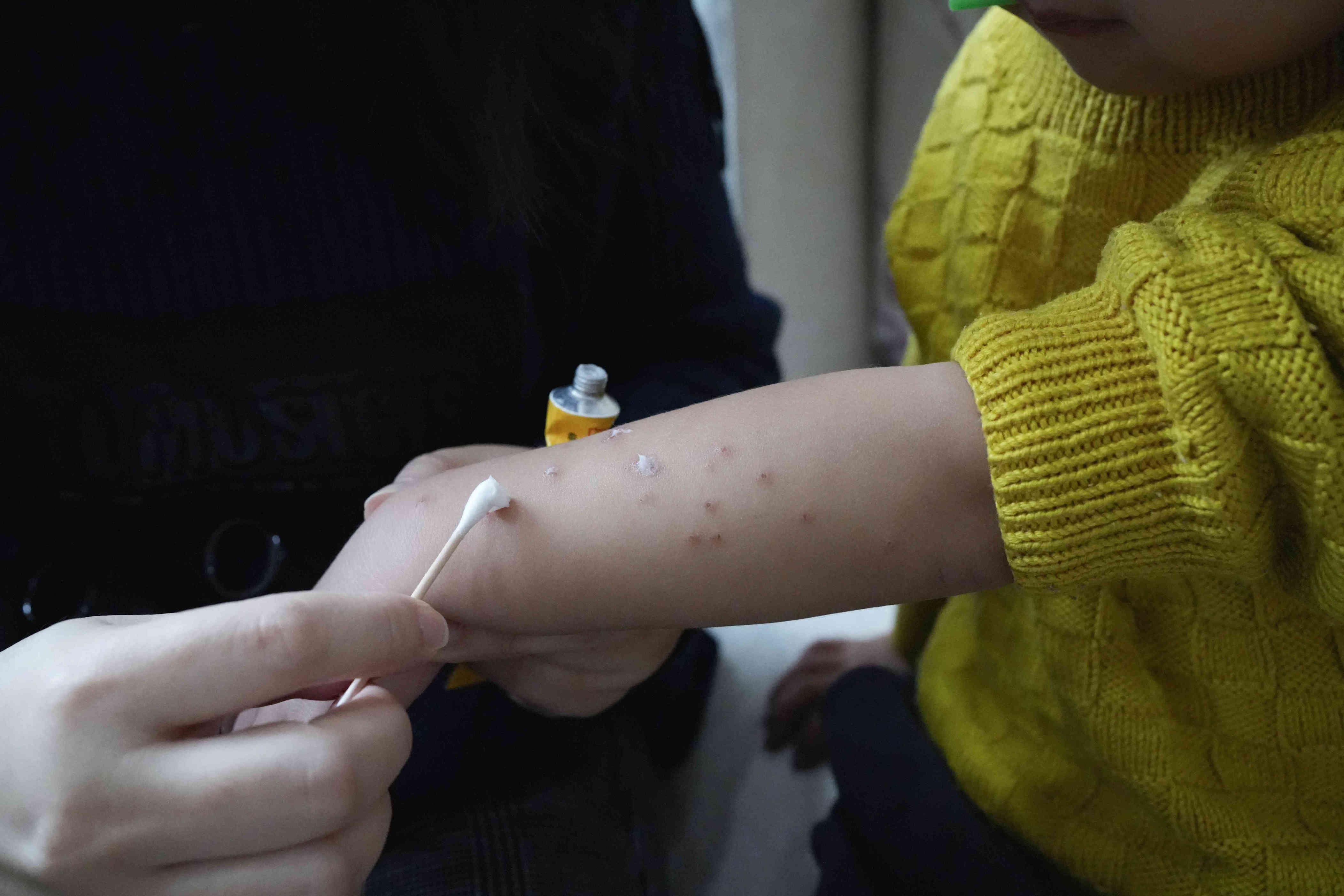 What To Know About Chickenpox (Varicella-Zoster Virus)