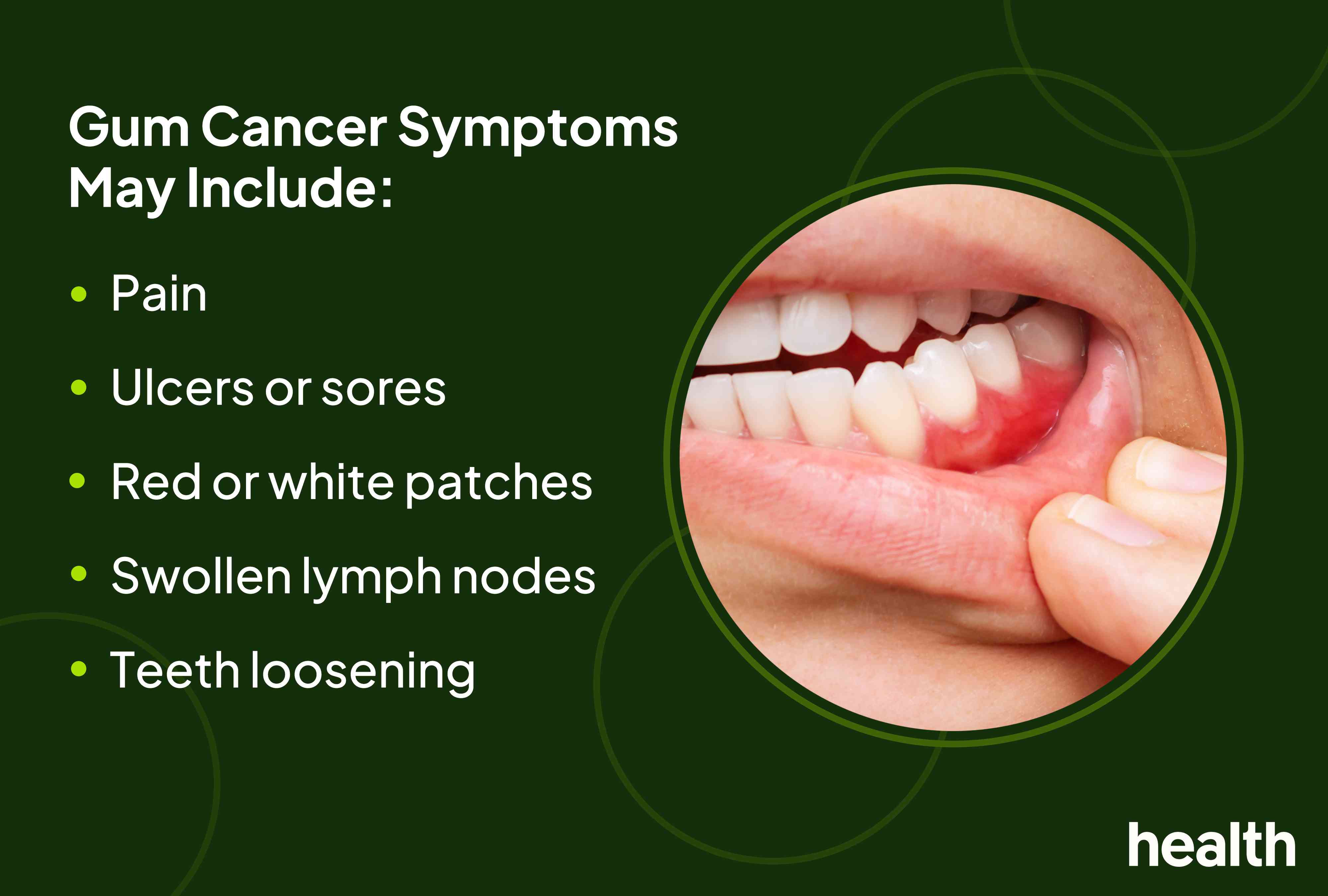 Signs and Symptoms of Gum Cancer (Gingiva Cancer)