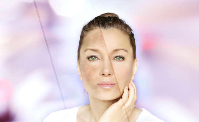 Effective ways to treat and prevent hyperpigmentation Effective ways to treat and prevent hyperpigmentation