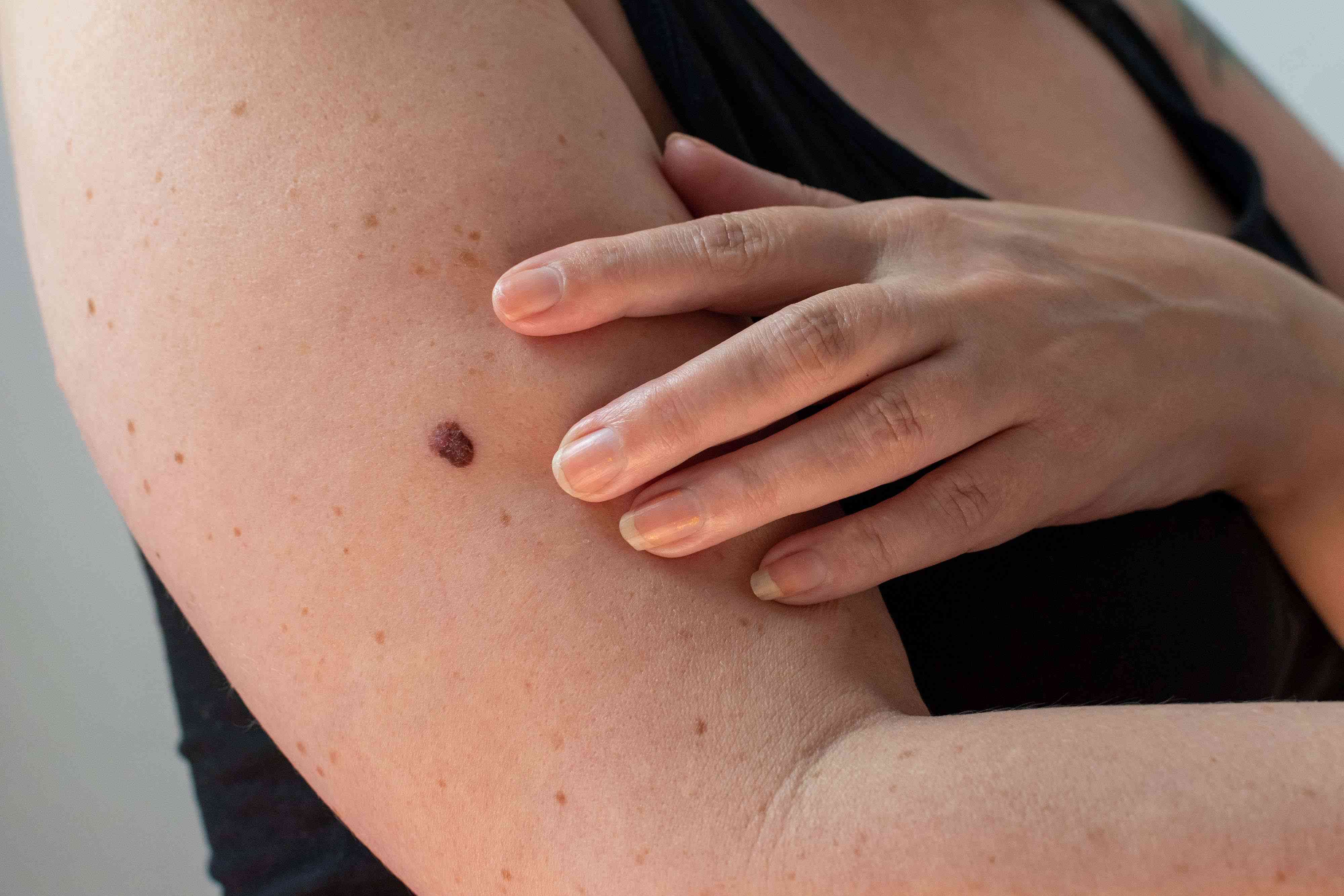 How to Tell the Difference Between Skin Cancer and a Mole