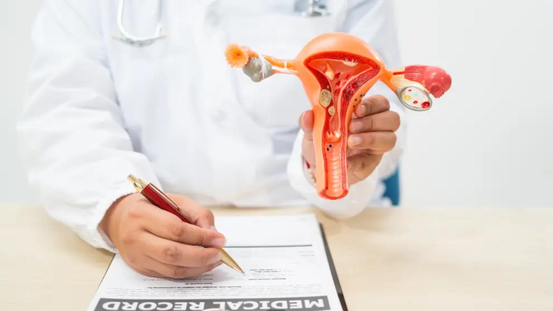 Así se manifiesta el cáncer de trompas de Falopio: estos son los ...