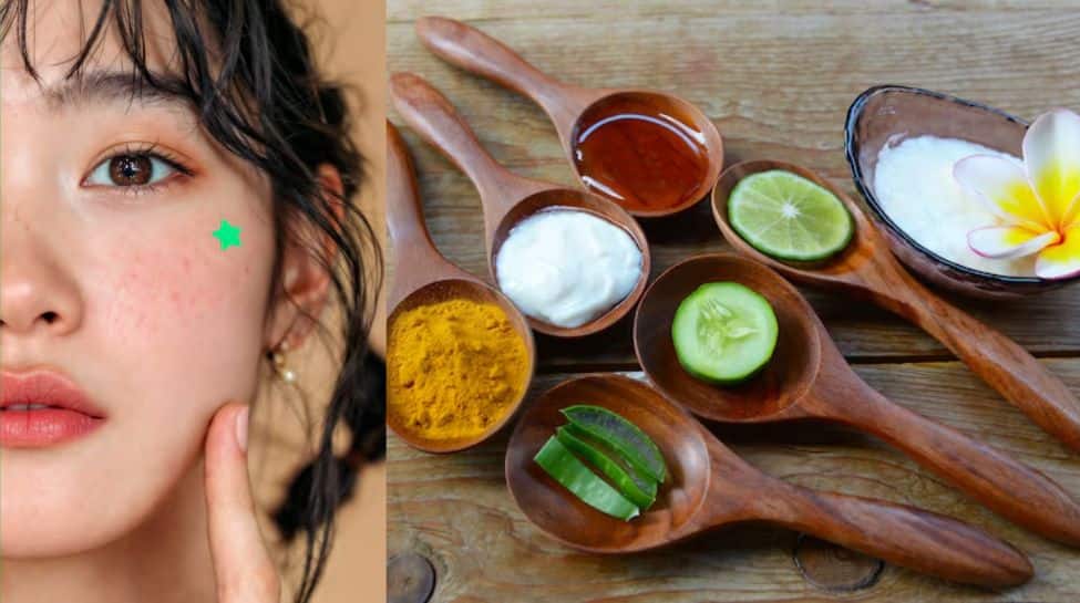 Natural Remedies For Acne And Pimples: 10 Popular DIY Face Packs For ...