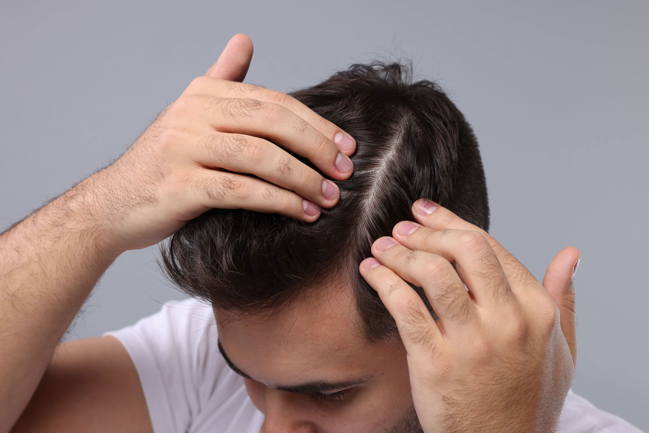 4 Ways Men Can Fix an Uneven Hairline 4 Ways Men Can Fix an Uneven Hairline