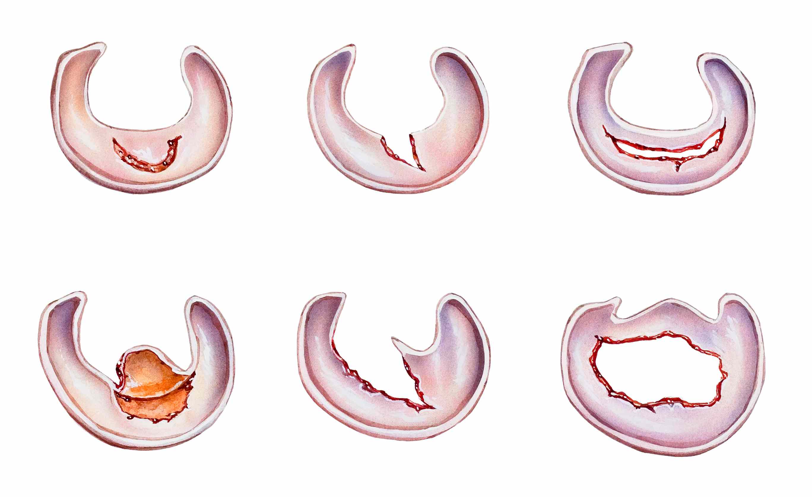 7 types of meniscus tears