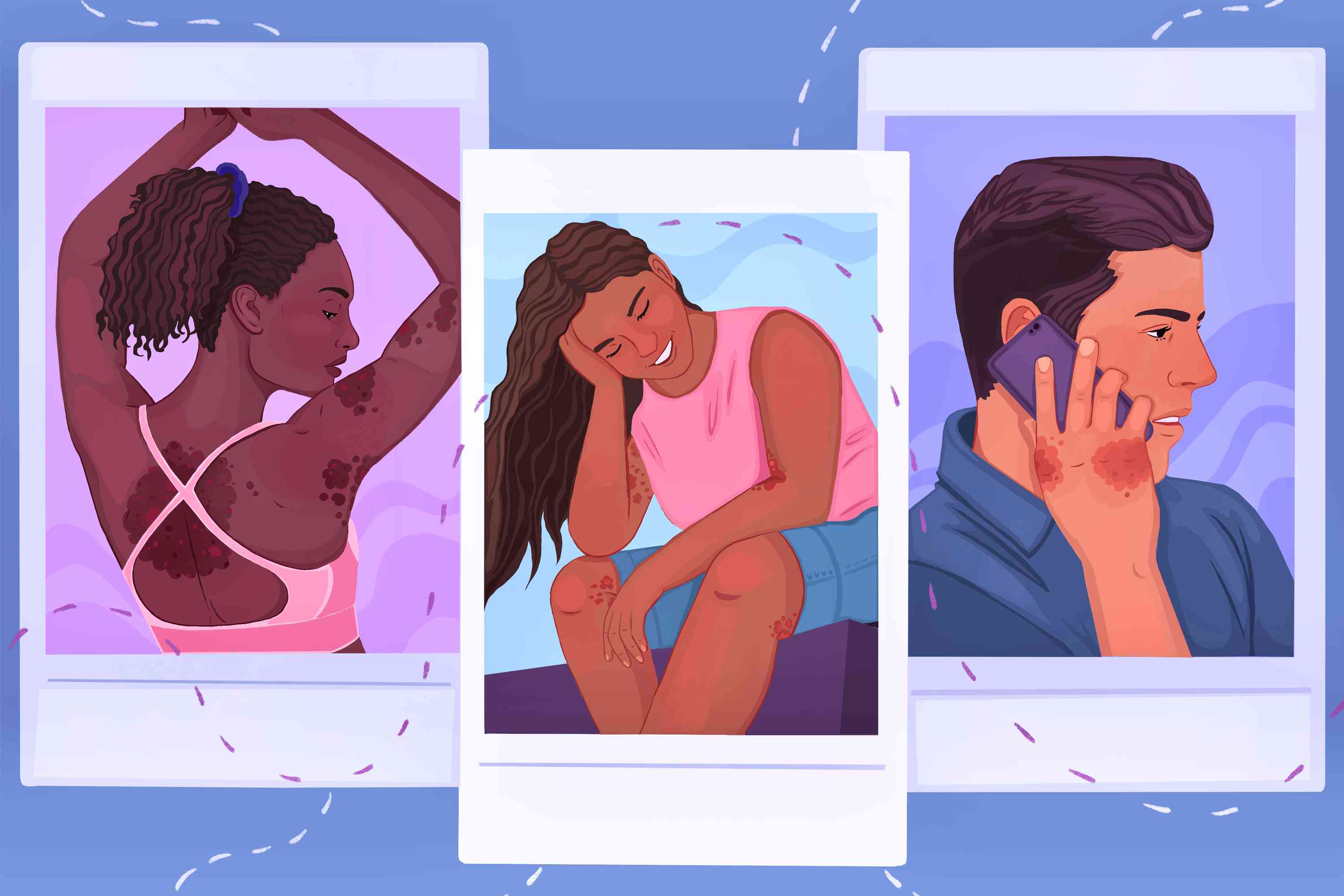 Eczema on dark skin: Common triggers, symptoms, and treatment