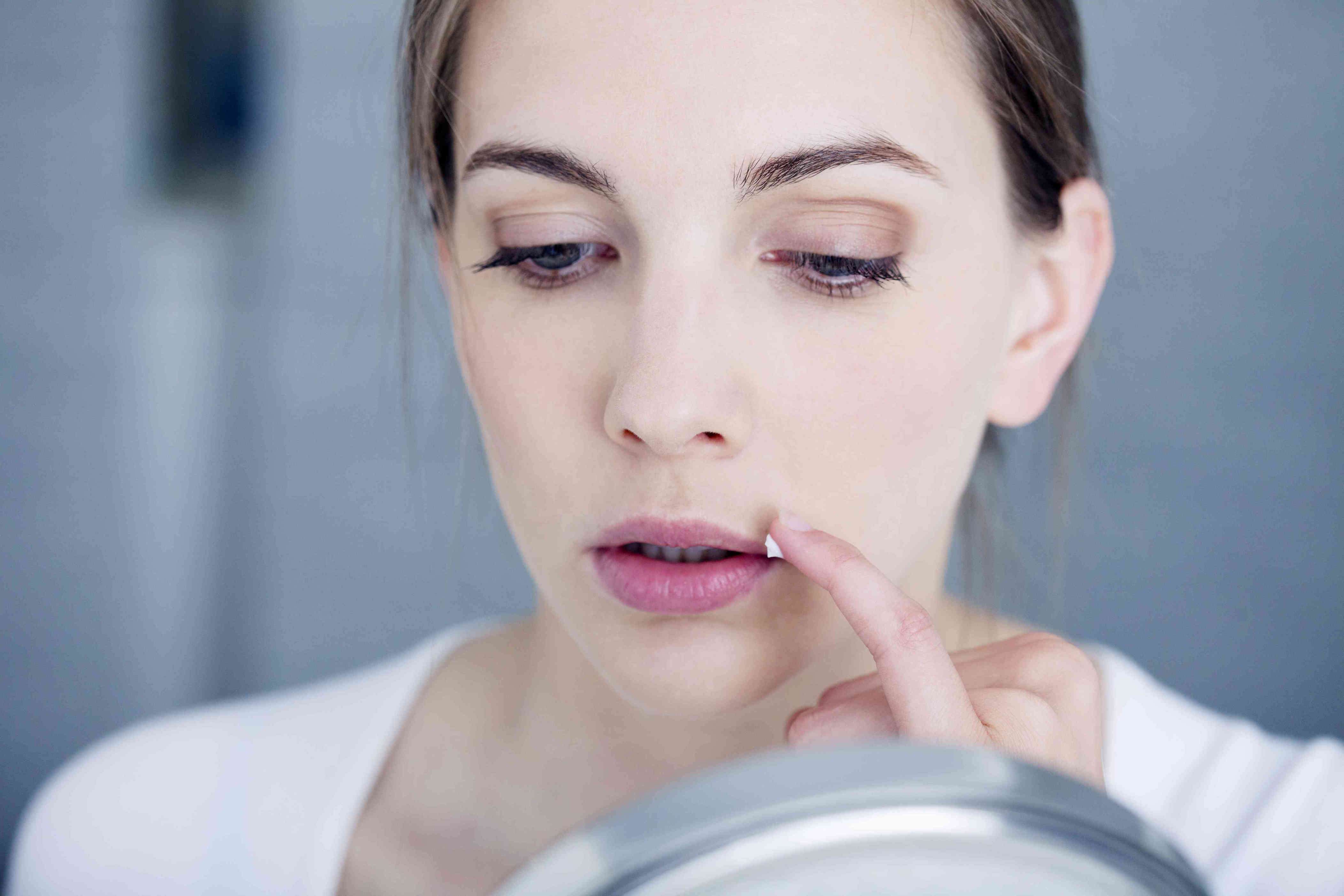 What is cheilitis?