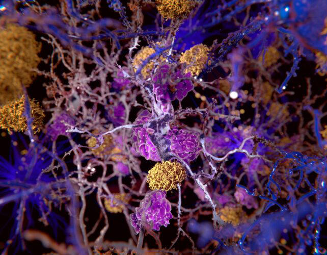 Common sleeping pill may reduce buildup of Alzheimer's proteins, study ...