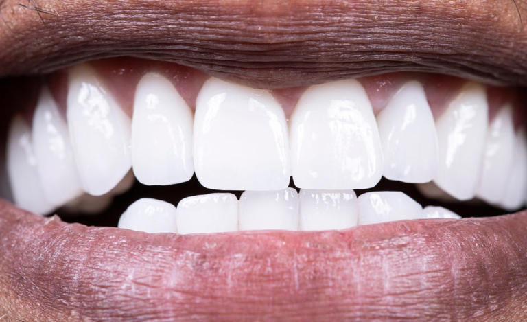 Calculus Bridge: What It Is, How to Prevent It and More