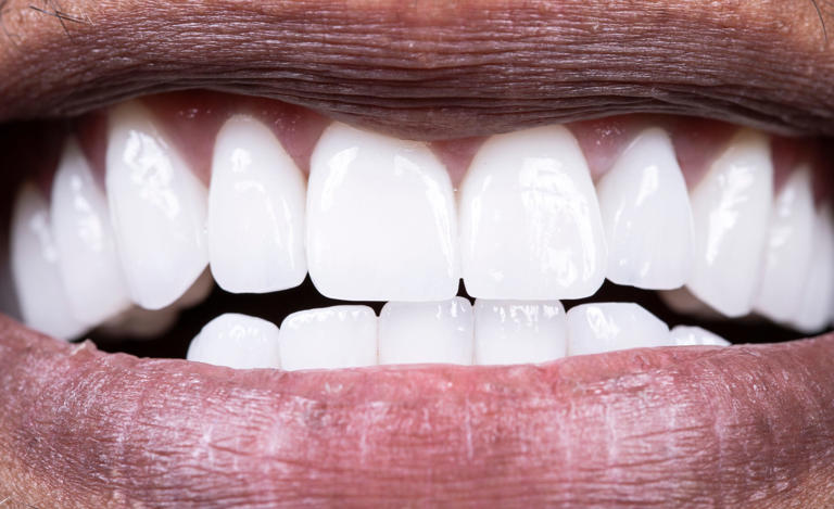 Calculus Bridge: What It Is, How to Prevent It and More